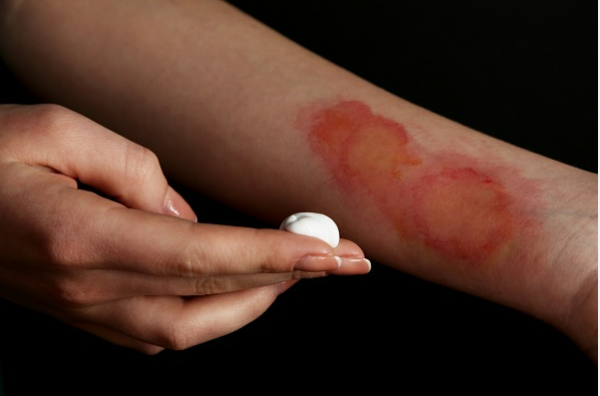 Burns First Aid: Immediate Steps to Take and Treatment Guidelines ...